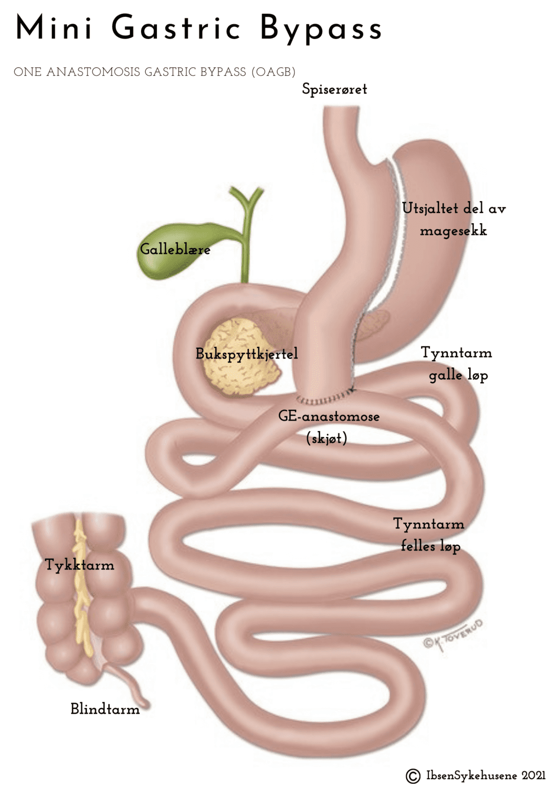 Mini Gastric Bypass - IbsenSykehusene